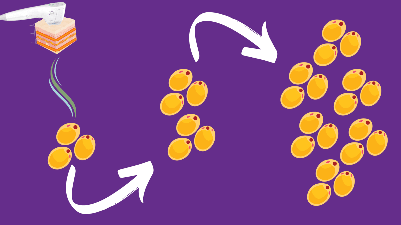 Using HIFU For Fat Loss, Skin Tightening and Fat Gain